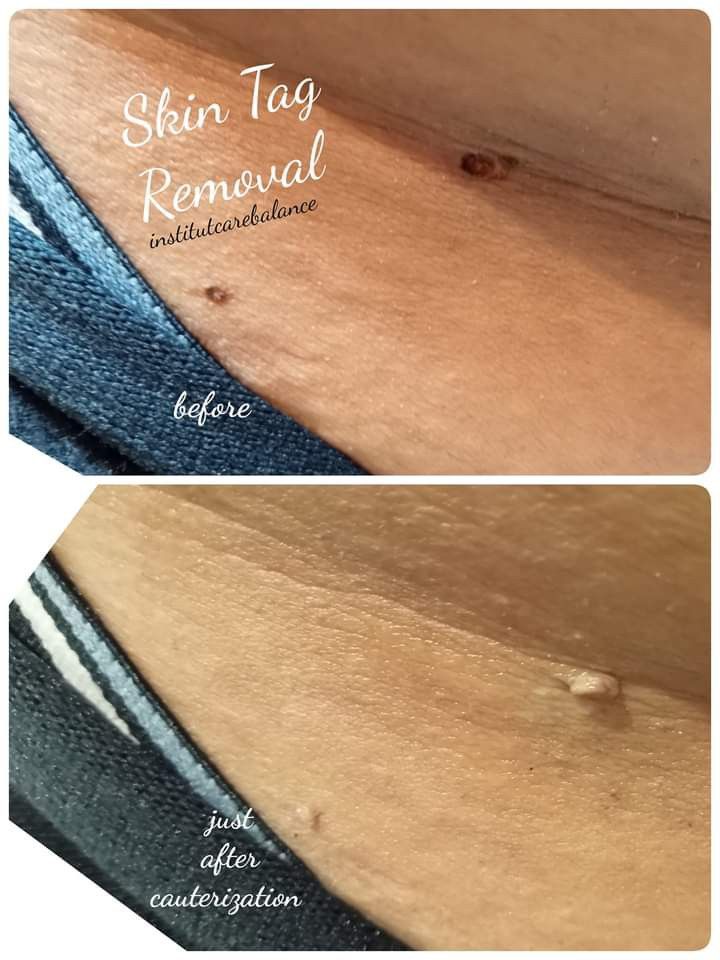 Milia Seed﻿,Skin Tag,Wart﻿,Syringoma,Tiny Bump,Oil Clog,Xanthelasma ...
