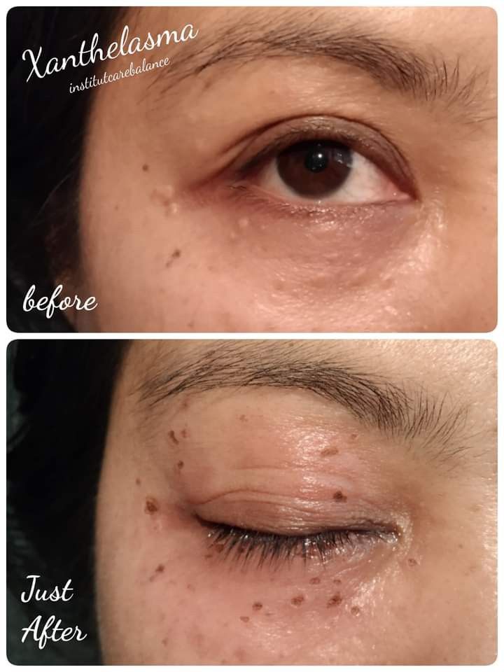 Milia Seed﻿,Skin Tag,Wart﻿,Syringoma,Tiny Bump,Oil Clog,Xanthelasma ...