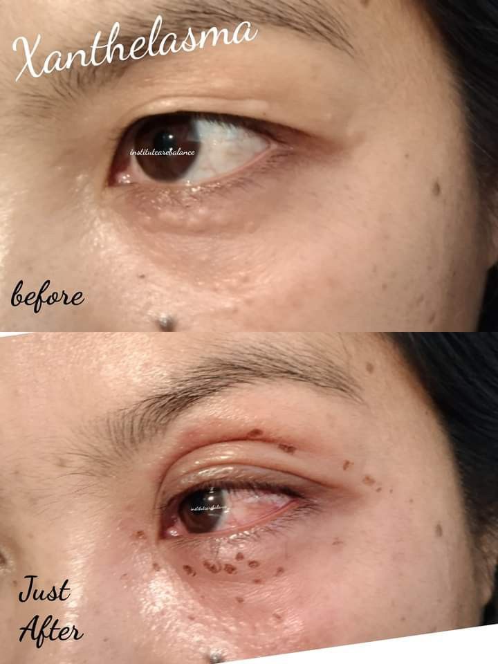 Milia Seed﻿,Skin Tag,Wart﻿,Syringoma,Tiny Bump,Oil Clog,Xanthelasma ...