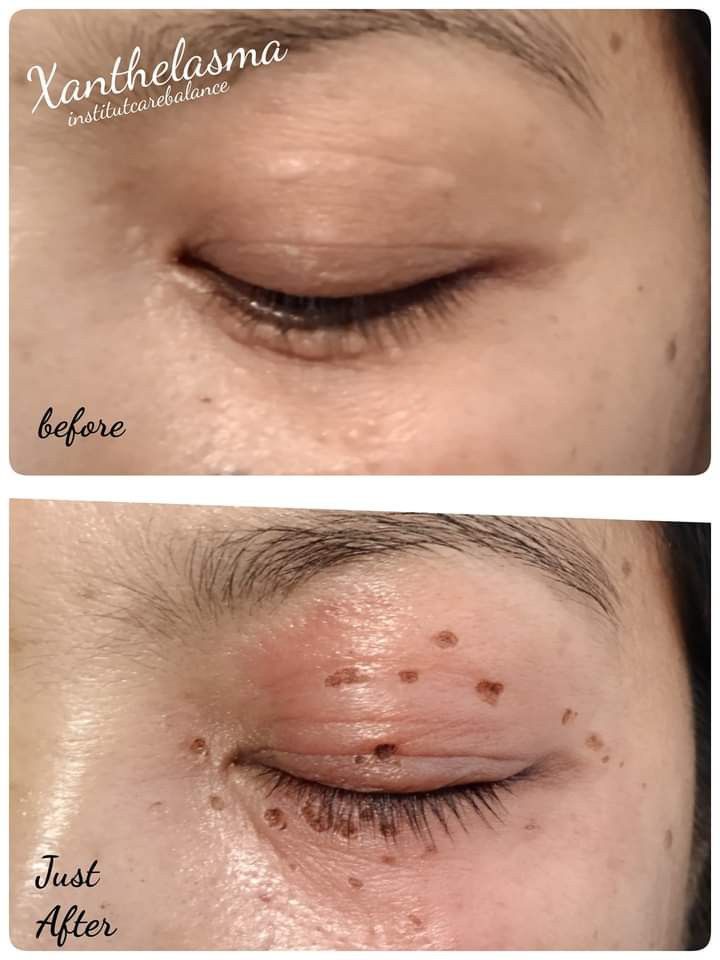 Milia Seed﻿,Skin Tag,Wart﻿,Syringoma,Tiny Bump,Oil Clog,Xanthelasma ...
