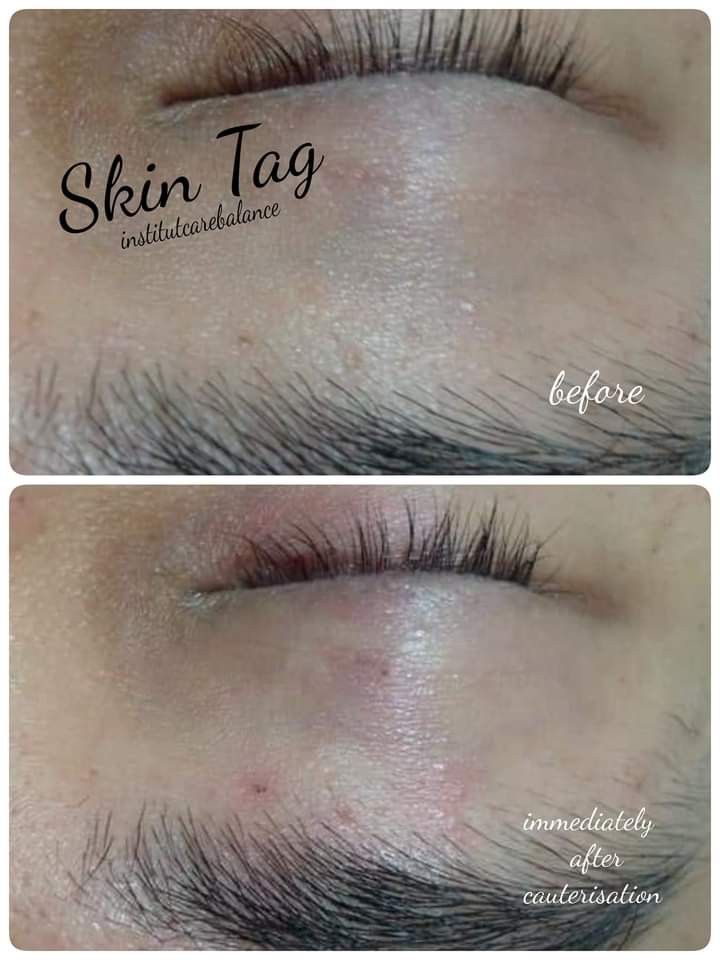 Milia Seed﻿,Skin Tag,Wart﻿,Syringoma,Tiny Bump,Oil Clog,Xanthelasma ...