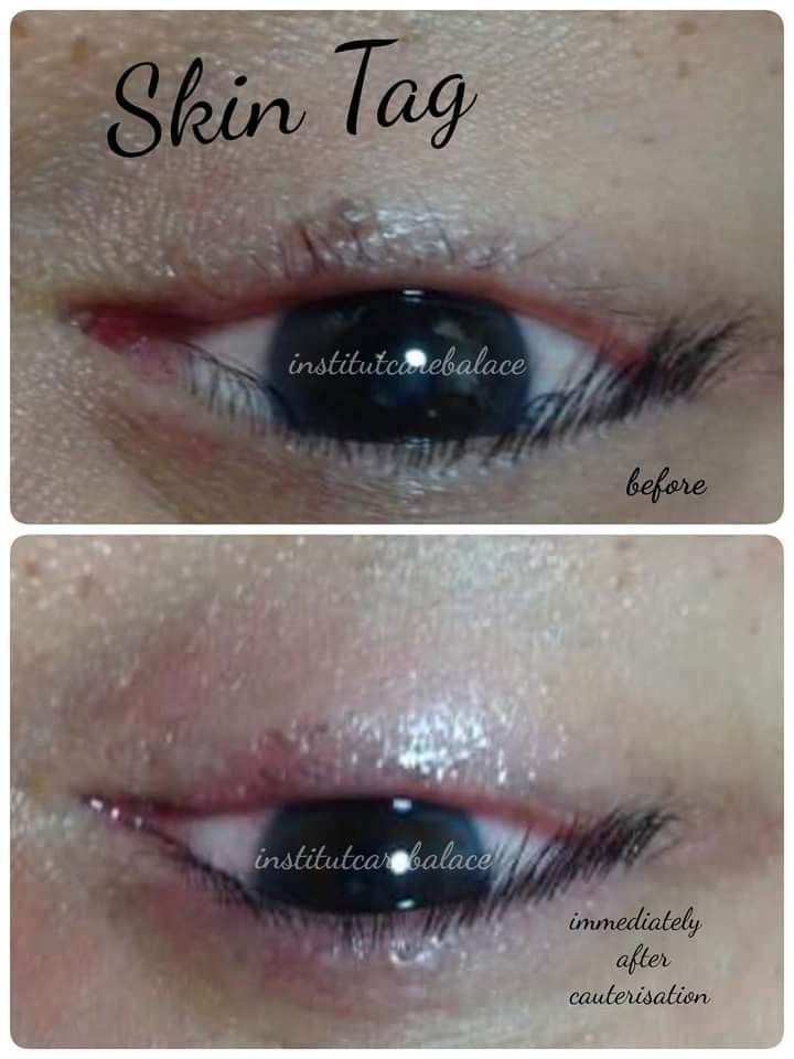 Milia Seed﻿,Skin Tag,Wart﻿,Syringoma,Tiny Bump,Oil Clog,Xanthelasma ...