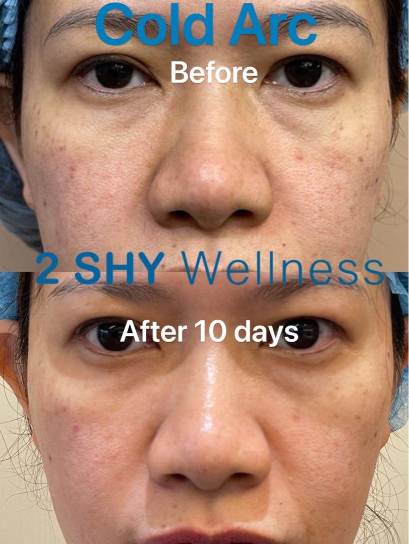 Hari Raya Promo: Pigmentations (sunspots, dermal spots & melasma ...