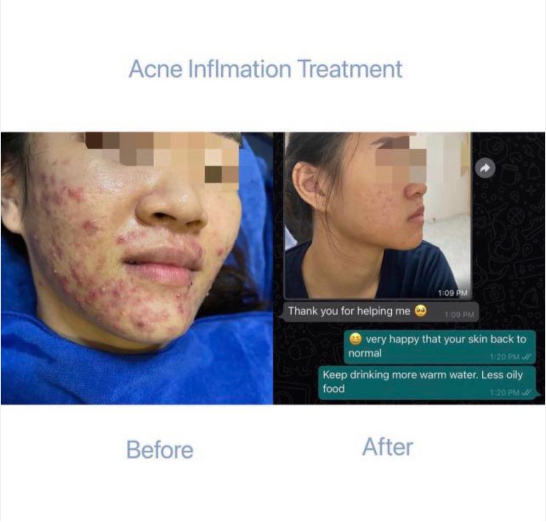 Cold (CRYO) plasma treatment for serious inflammation, acne marks, anti ...