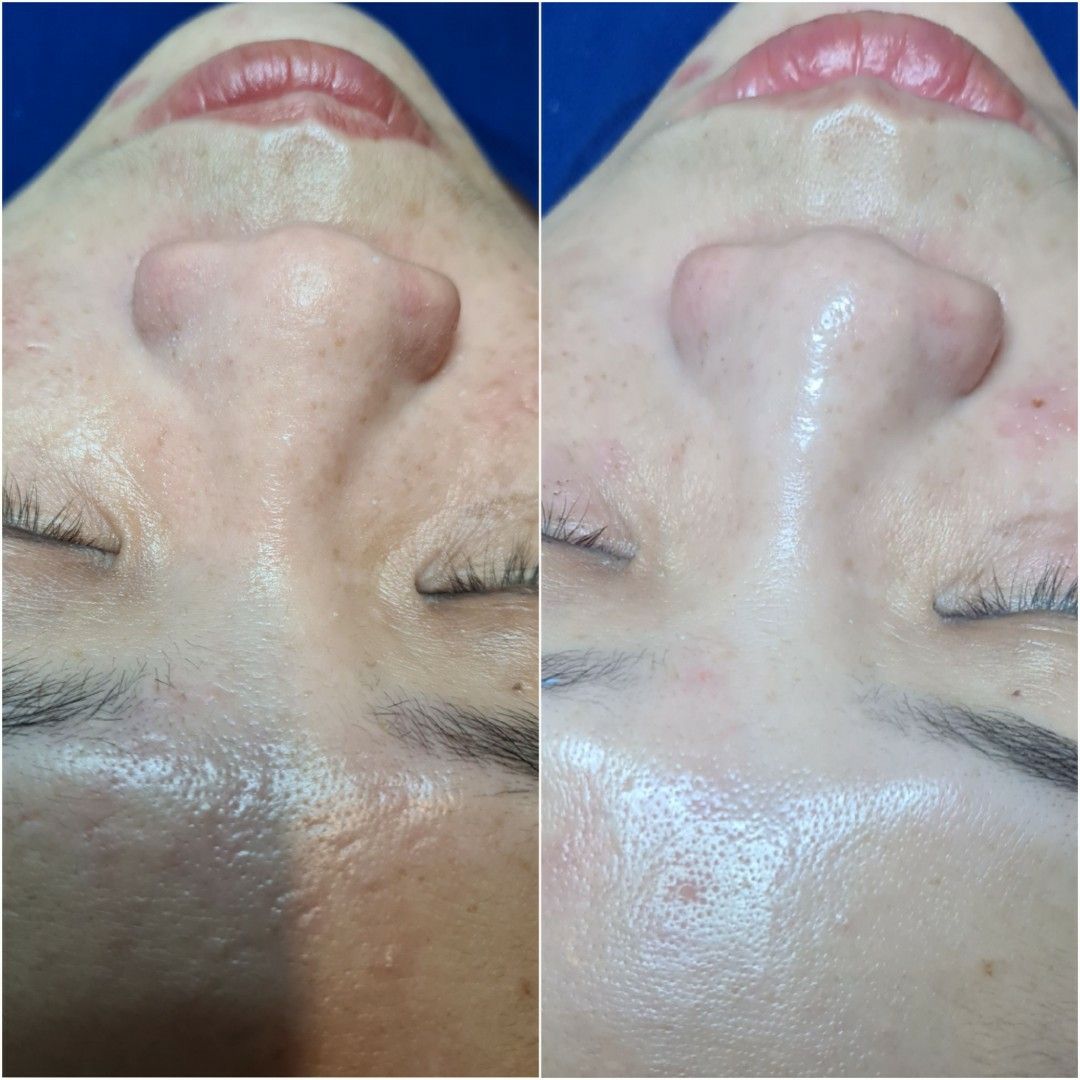 2Way Nano meso white skin rejuvenation whiten brightens clear acne ...