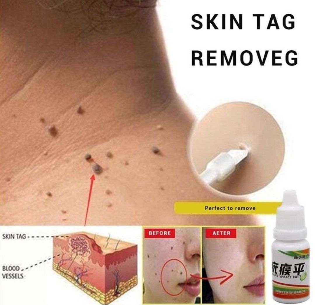 Skin Tag Mole Remover Warts Natural Remedy Skin Problems Effective ...