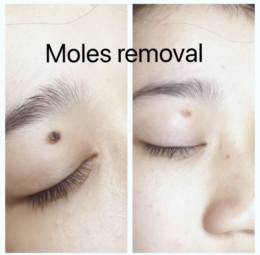 Moles Removal, Beauty & Personal Care, Face, Face Care on Carousell