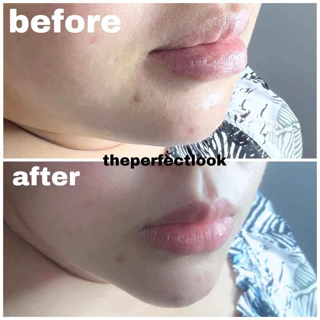 Chin enhancement . Change shape (VShaped) and unbalanced chin . non ...