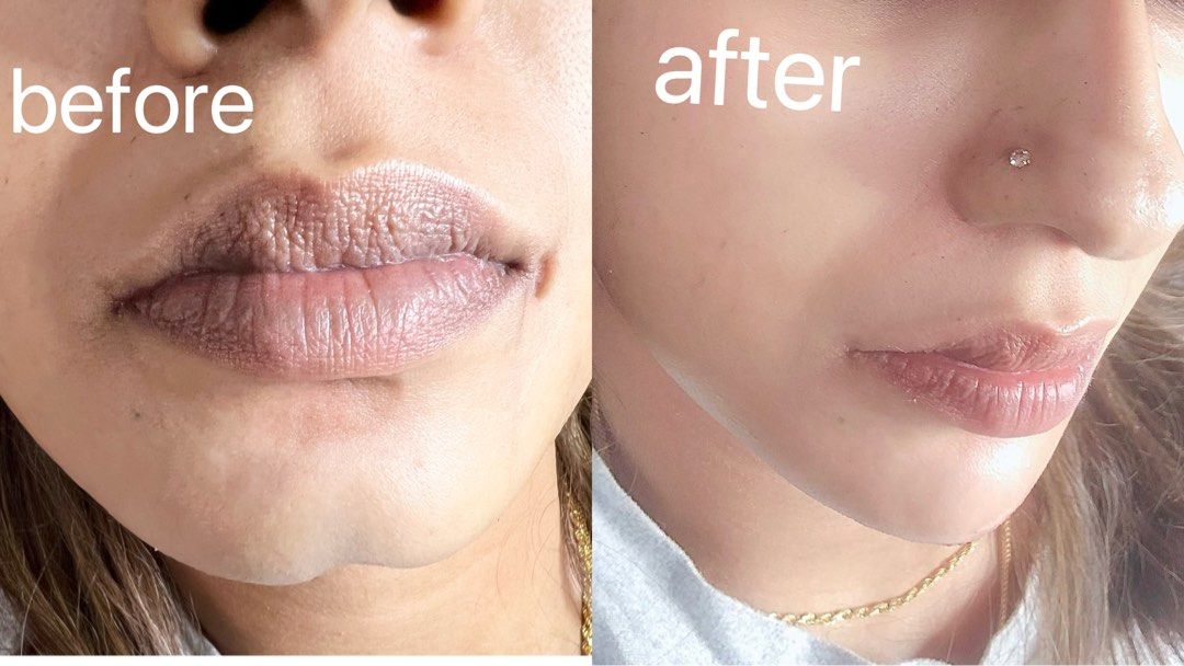 Chin enhancement . Change shape (VShaped) and unbalanced chin . non ...