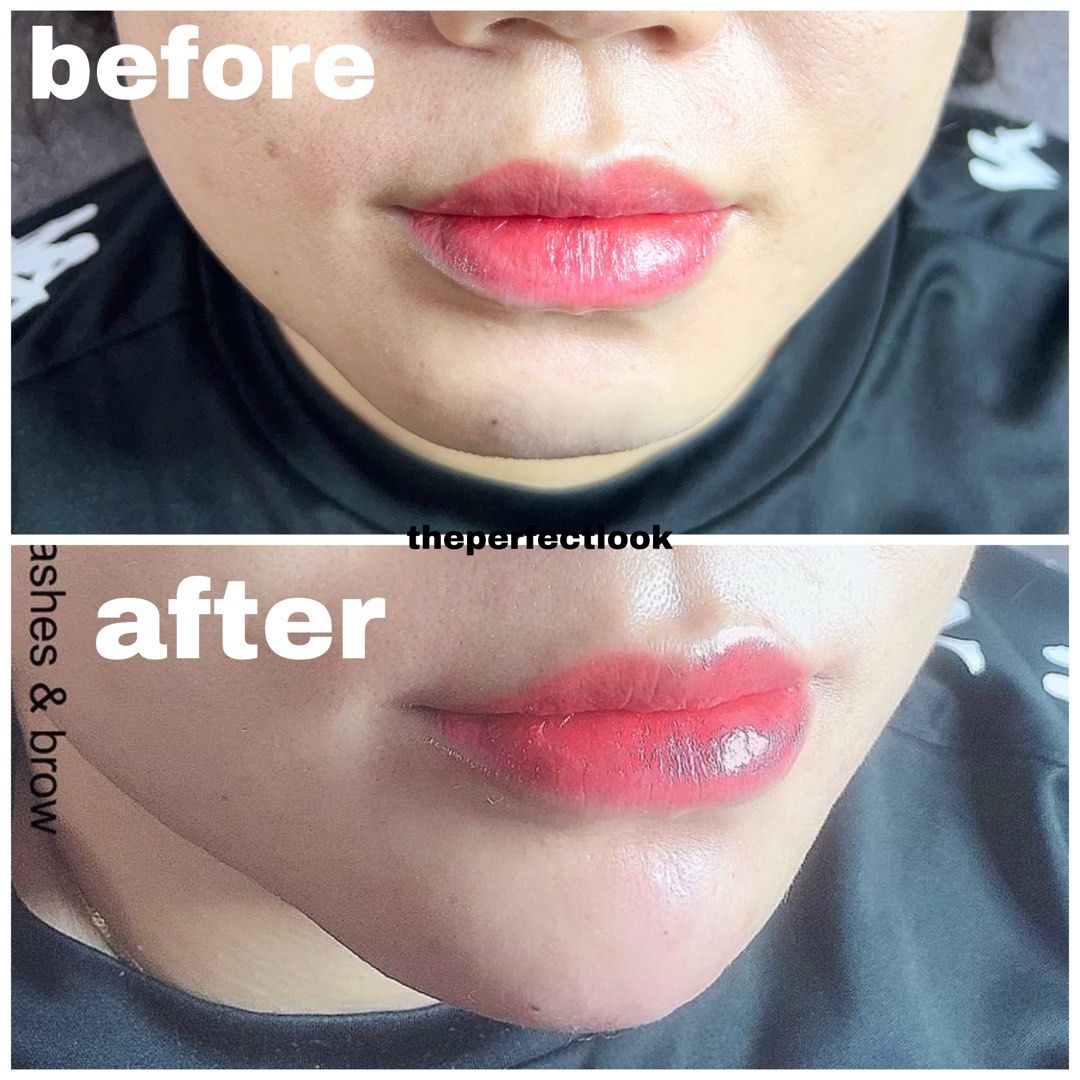 Chin enhancement . Change shape (VShaped) and unbalanced chin . non ...