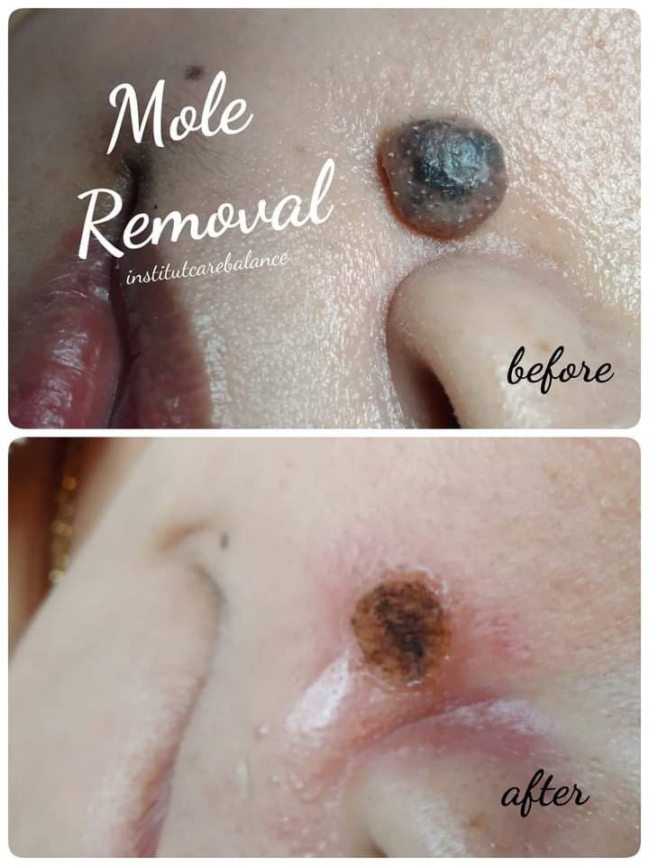 Milia Seed﻿,Skin Tag,Wart﻿,Syringoma,Tiny Bump,Oil Clog,Xanthelasma,Cholesterol, Mole﻿,Sebaceous ...