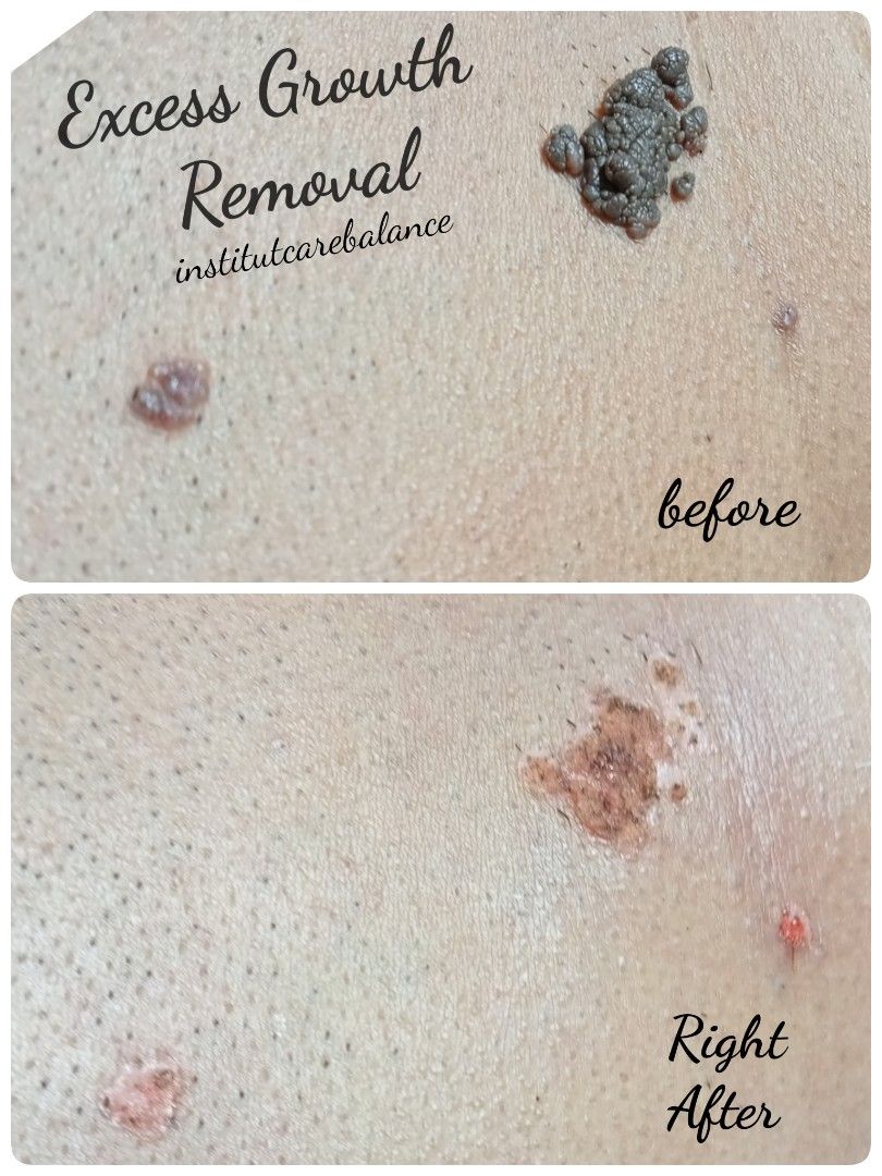 Milia Seed﻿,Skin Tag,Wart﻿,Syringoma,Tiny Bump,Oil Clog,Xanthelasma ...