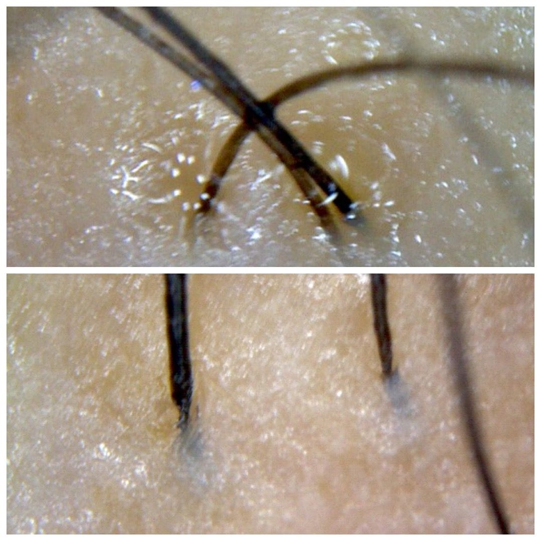 Hydra Scalp Deep Detox Cleansing Peeling with professional machine ...