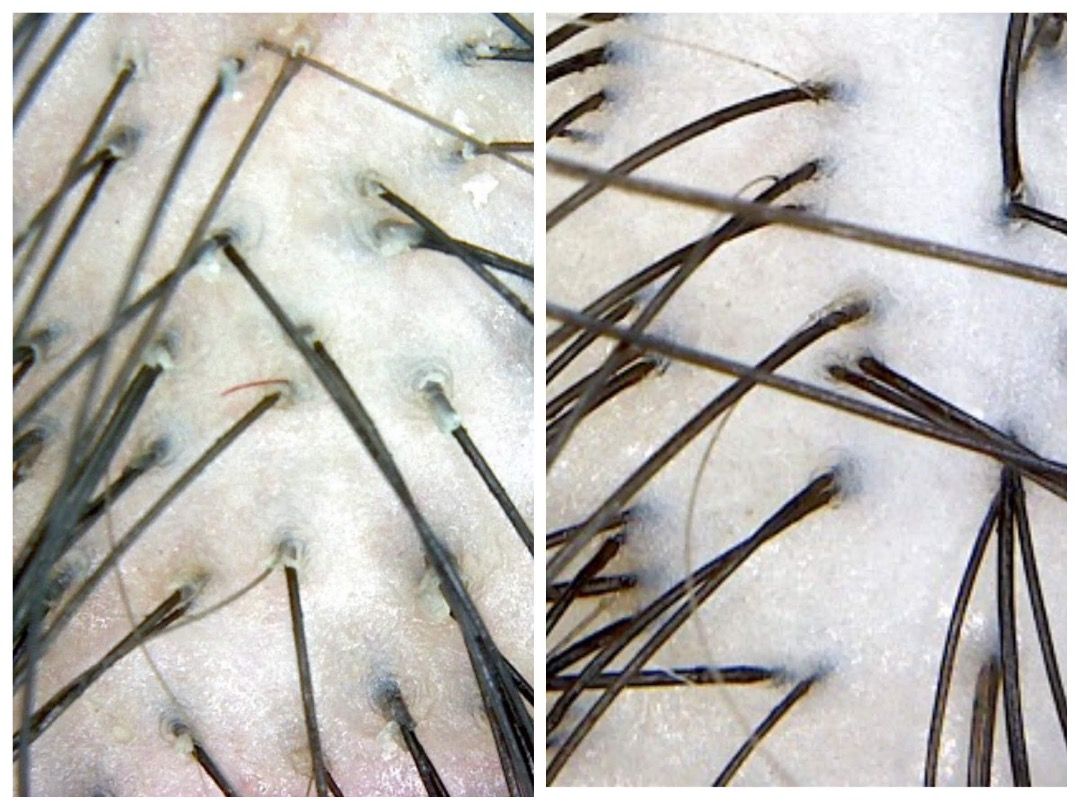 Hydra Scalp Deep Detox Cleansing Peeling with professional machine ...