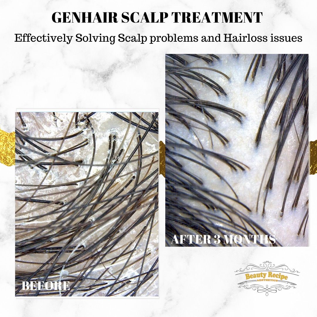 Hydra Scalp Deep Detox Cleansing Peeling with professional machine ...