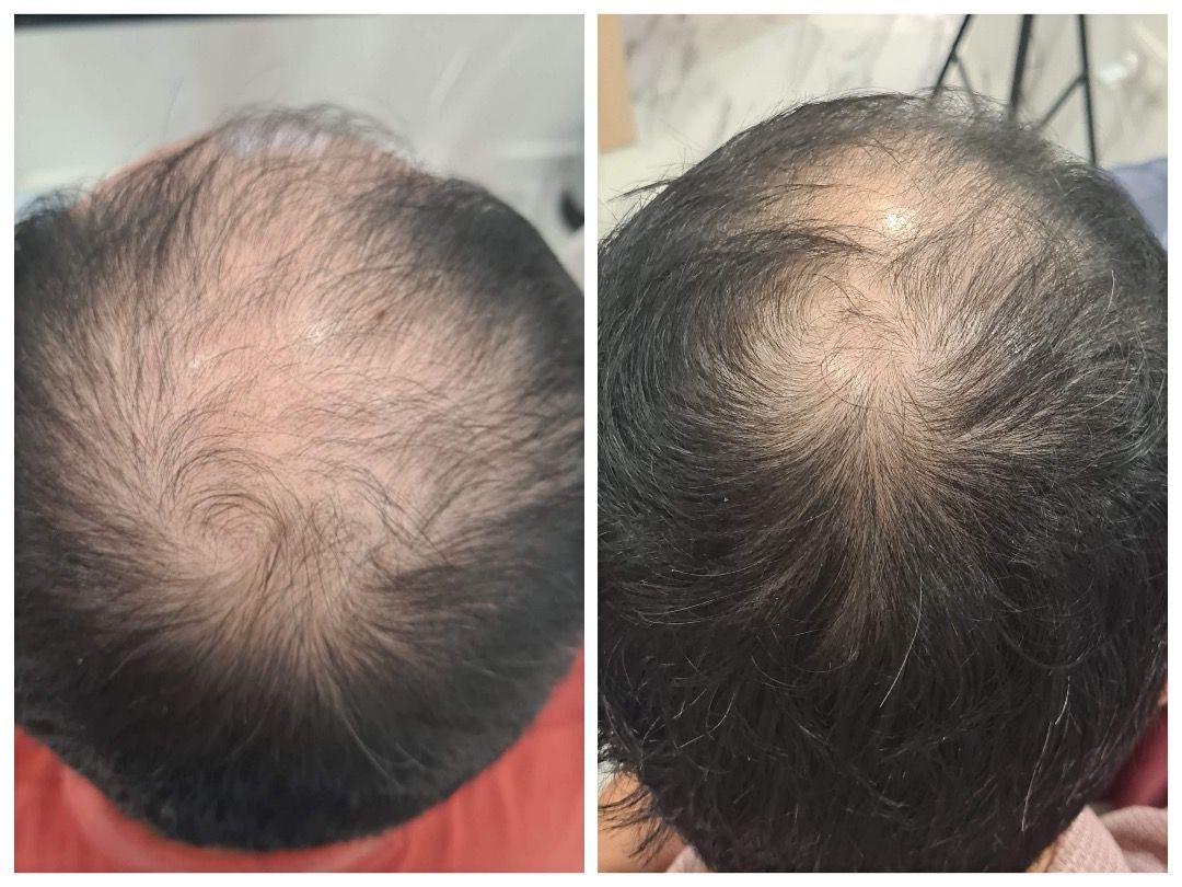 Stem Cell with Microneedling PRP hair loss hair growth scalp renewal ...