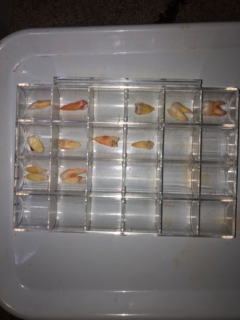 Natural Teeth Extracted teeth Natural tooth Dental, Health & Nutrition ...