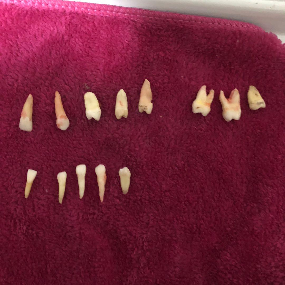 Natural Teeth Extracted teeth Natural tooth Dental, Health & Nutrition ...