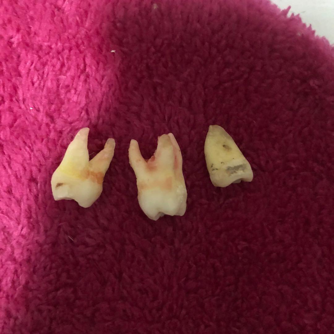 Natural Teeth Extracted teeth Natural tooth Dental, Health & Nutrition ...