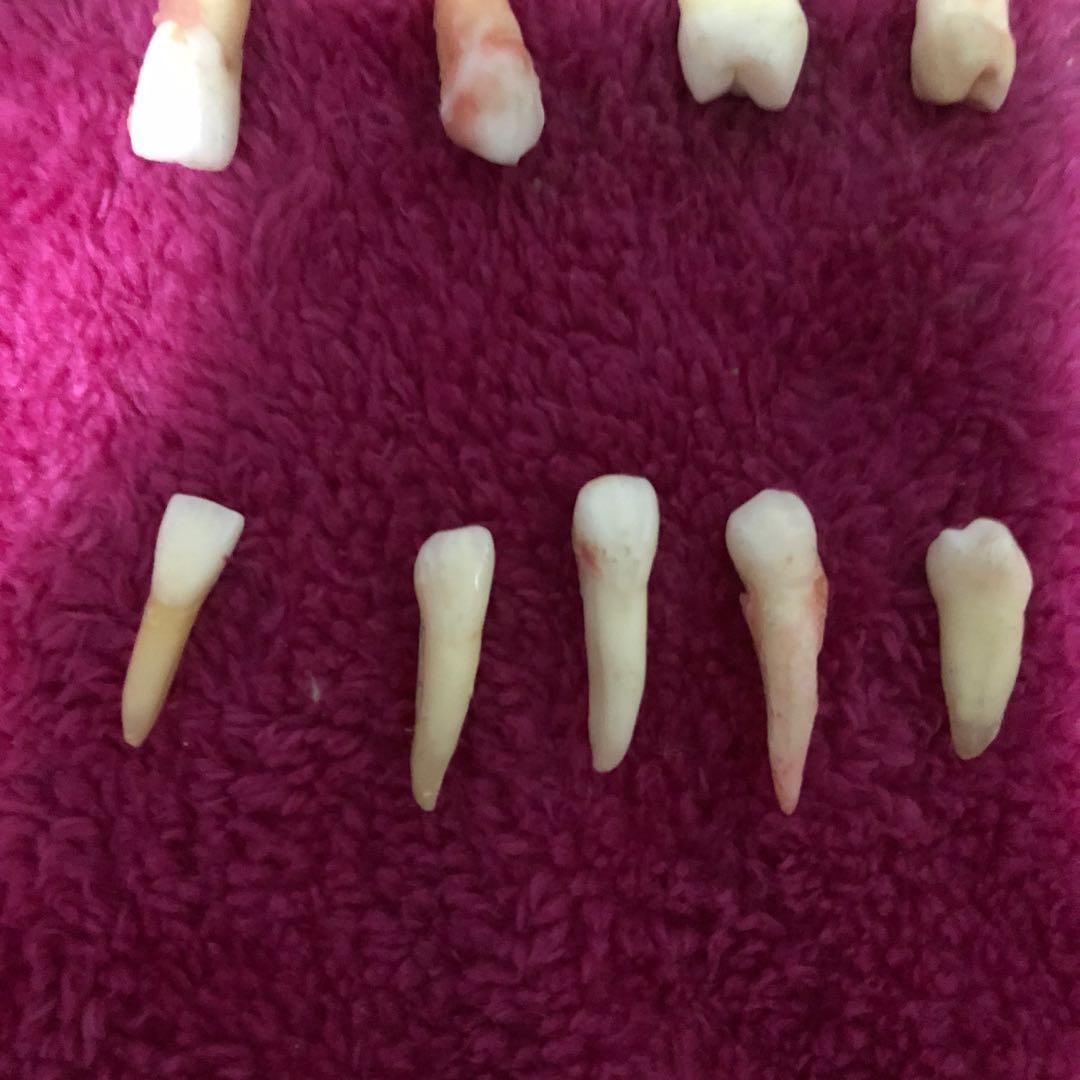 Natural Teeth Extracted teeth Natural tooth Dental, Health & Nutrition ...