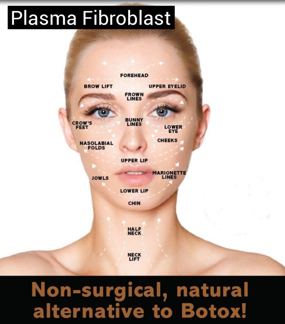 Plasma Fibroblast Facial Skin Tightening@Woodlands, Beauty & Personal ...