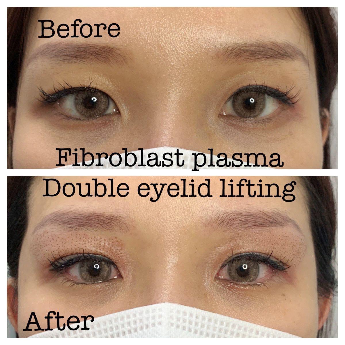FIBROBLAST PLASMA LIFT/Double eyelid/Scar/Stretch mark/Wrinkle ...