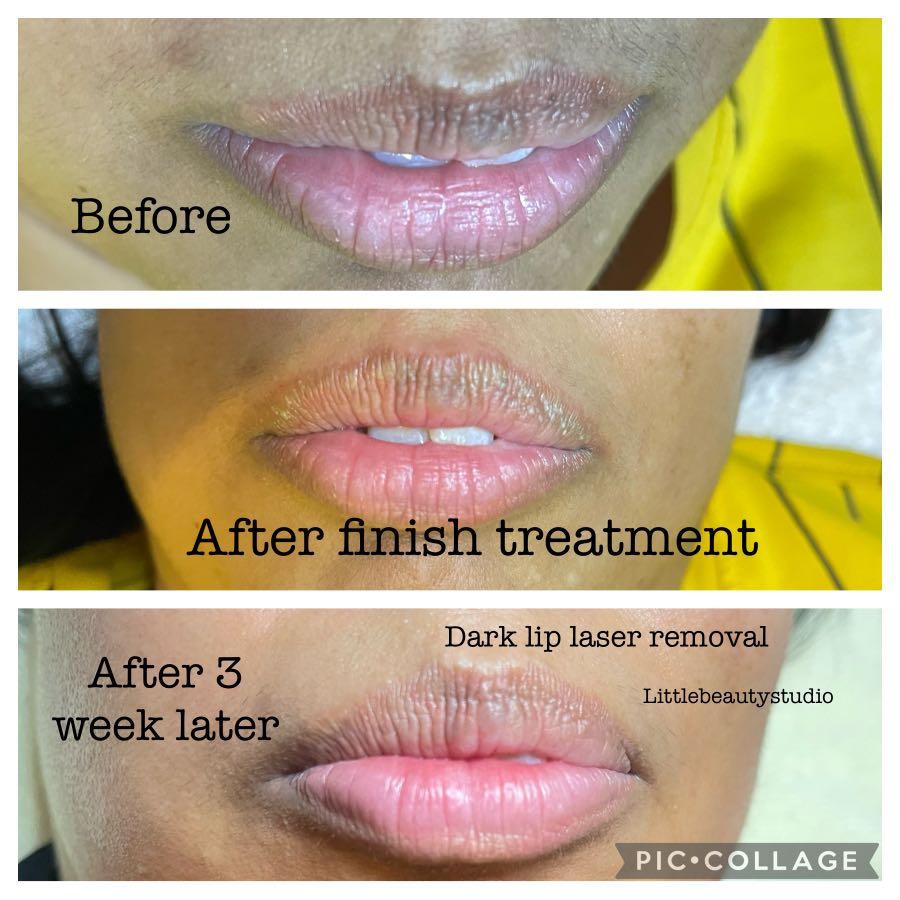Lip laser dark pigment removal, Lifestyle Services, Beauty & Health ...