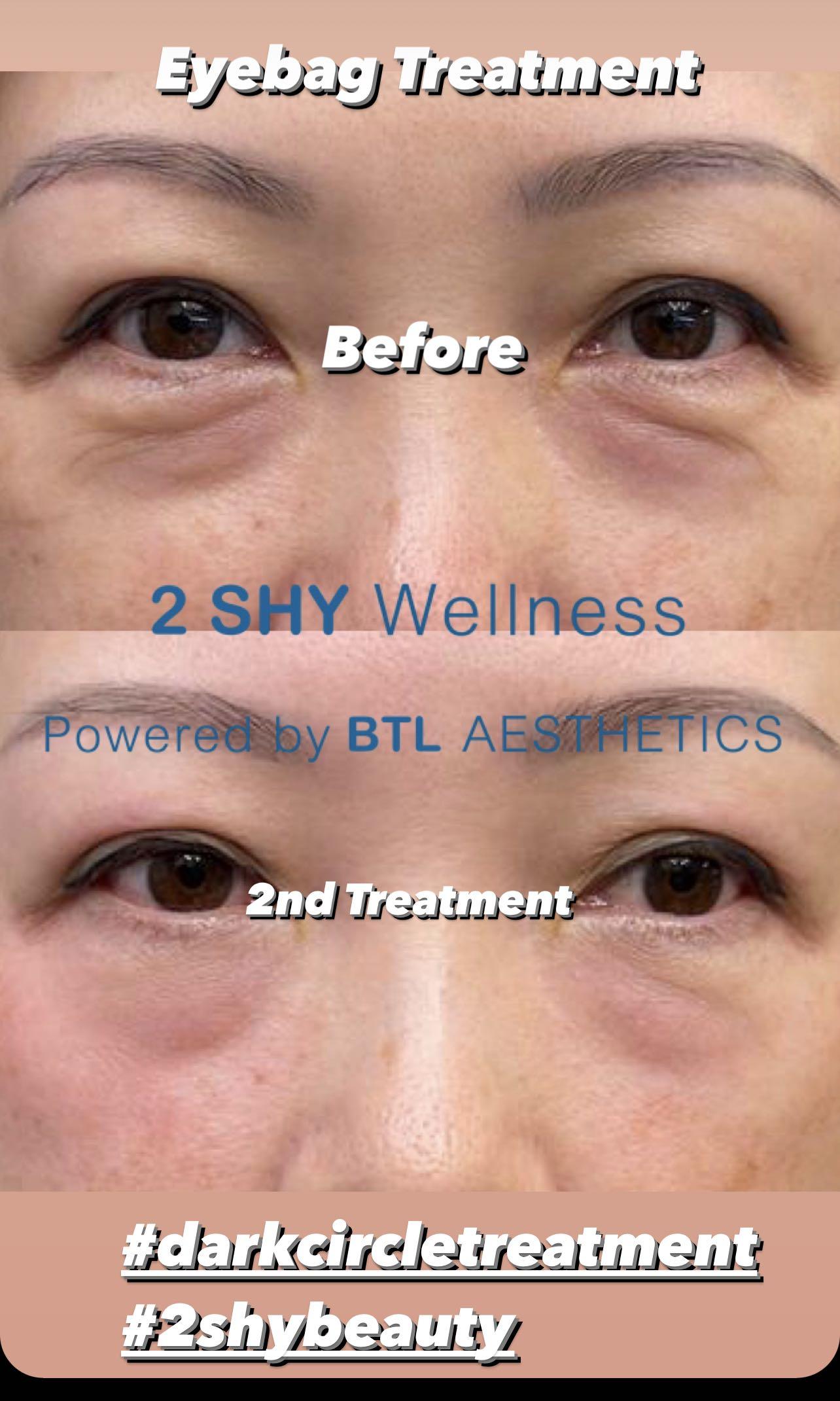 Healthy Promo: Eye bag Tightening , Lifestyle Services, Beauty & Health ...