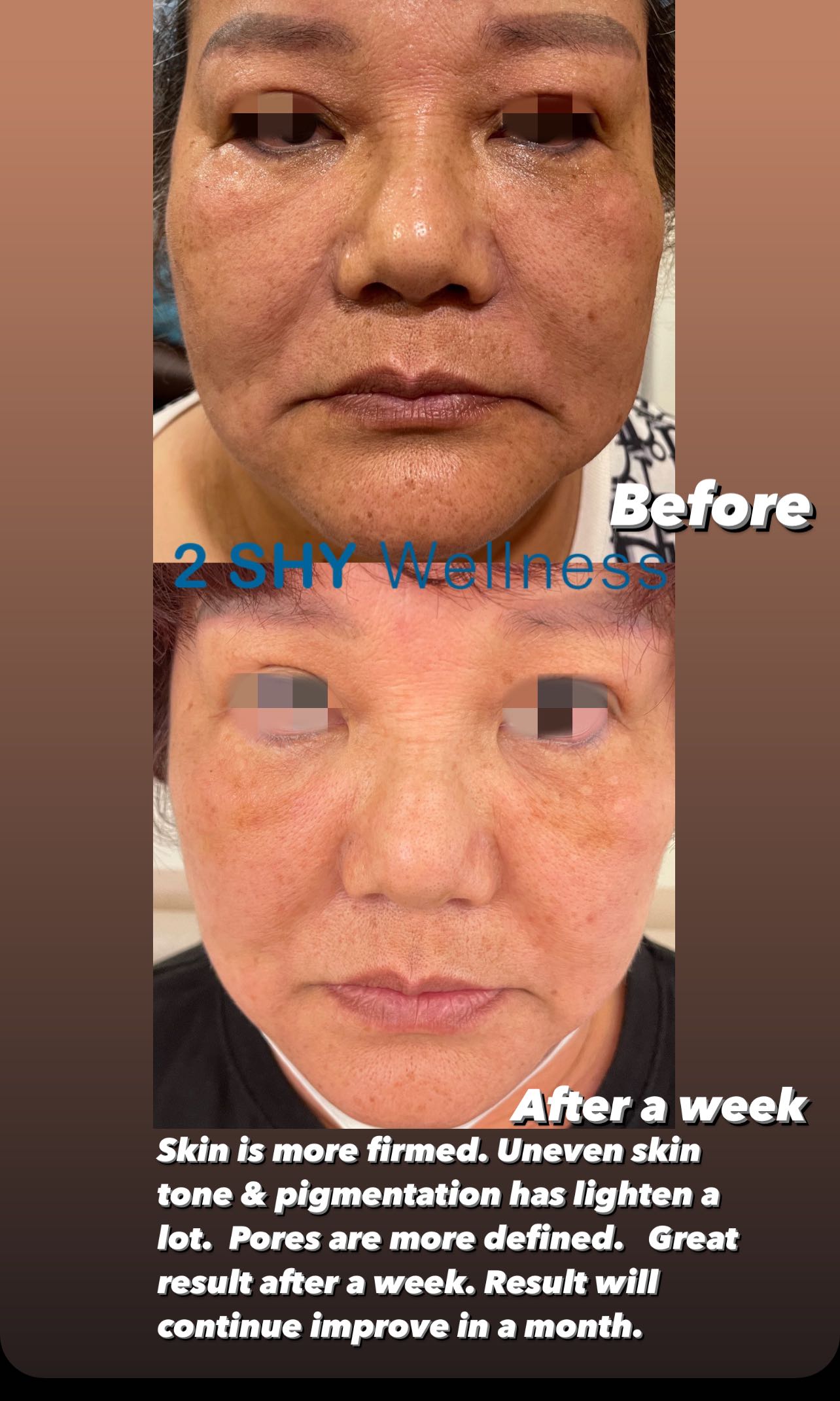 Hari Raya PROMO: All in one face treatment (acne, new scars, acne marks ...