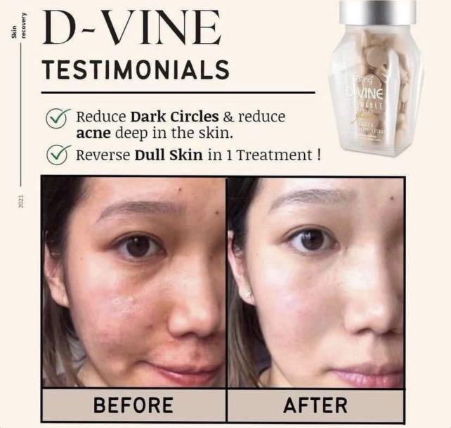 D-Vine Whitening & Acne Tablet, Beauty & Personal Care, Face, Face Care ...