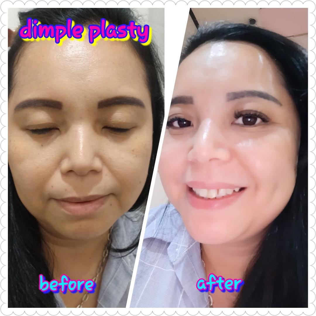dimple creation no incision / non surgery, Beauty & Personal Care, Face ...