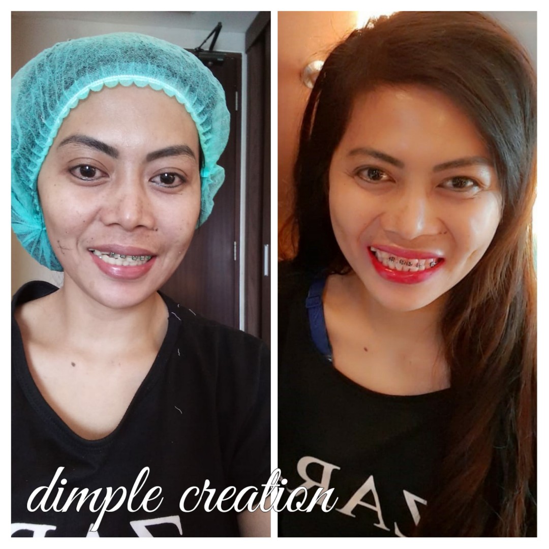 dimple plasty / dimple creation without incision, Beauty & Personal ...