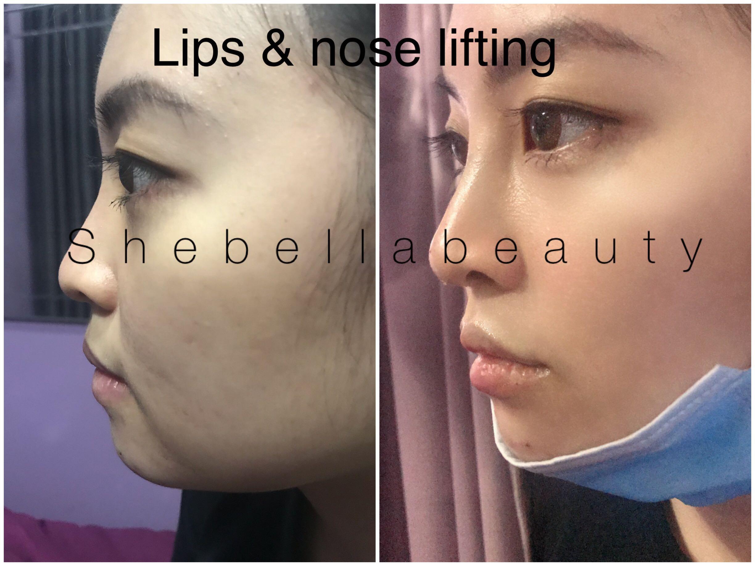 Nose bridge , collagen on eye , chin , lips , all face area without ...