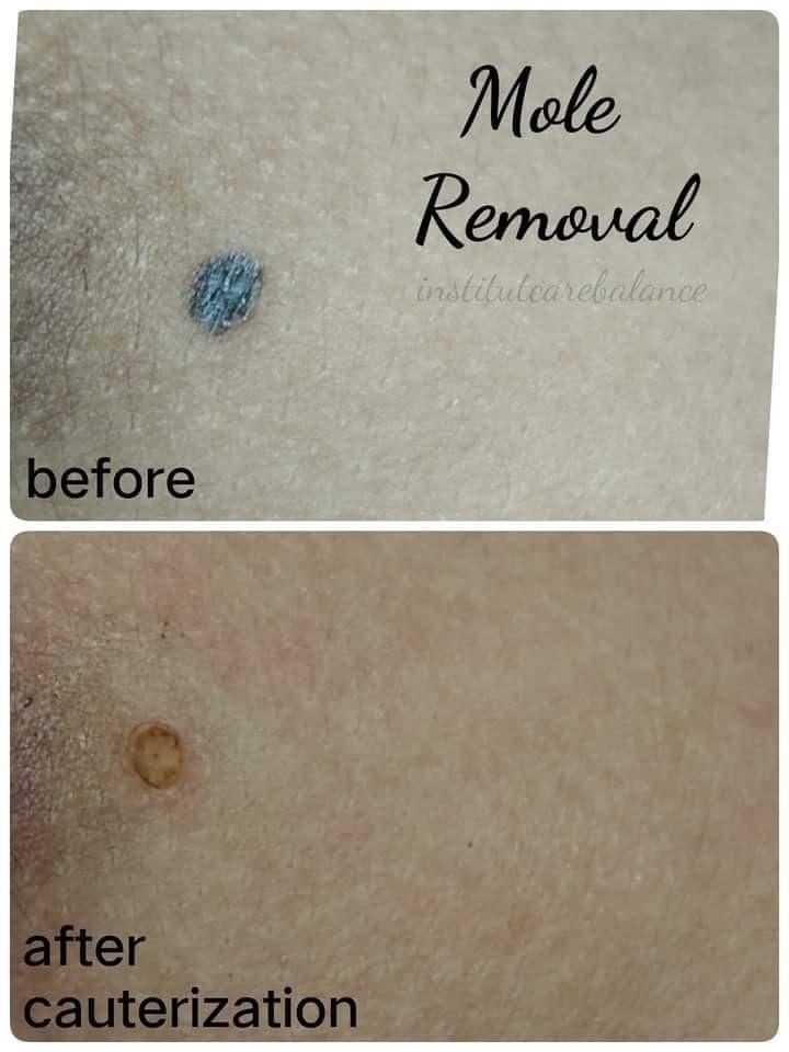 Milia Seed﻿,Skin Tag,Wart﻿,Syringoma,Tiny Bump,Oil Clog,Xanthelasma ...