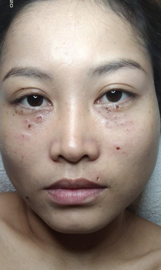 Milia Seed﻿,Skin Tag,Wart﻿,Syringoma,Tiny Bump,Oil Clog,Xanthelasma ...