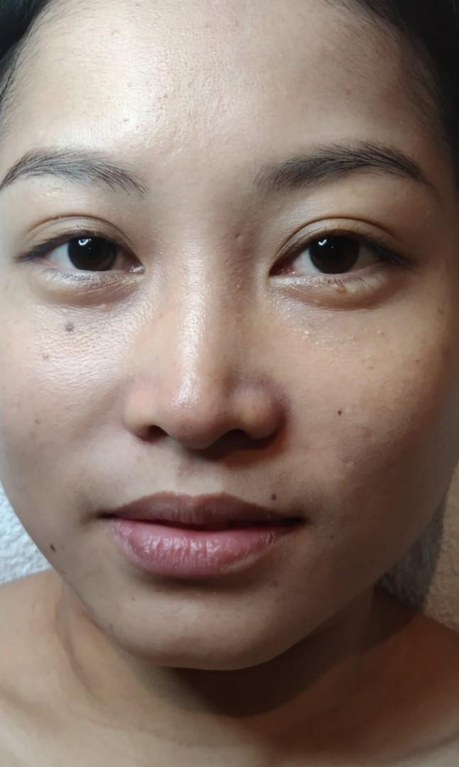 Milia Seed﻿,Skin Tag,Wart﻿,Syringoma,Tiny Bump,Oil Clog,Xanthelasma,Cholesterol, Mole﻿,Sebaceous ...