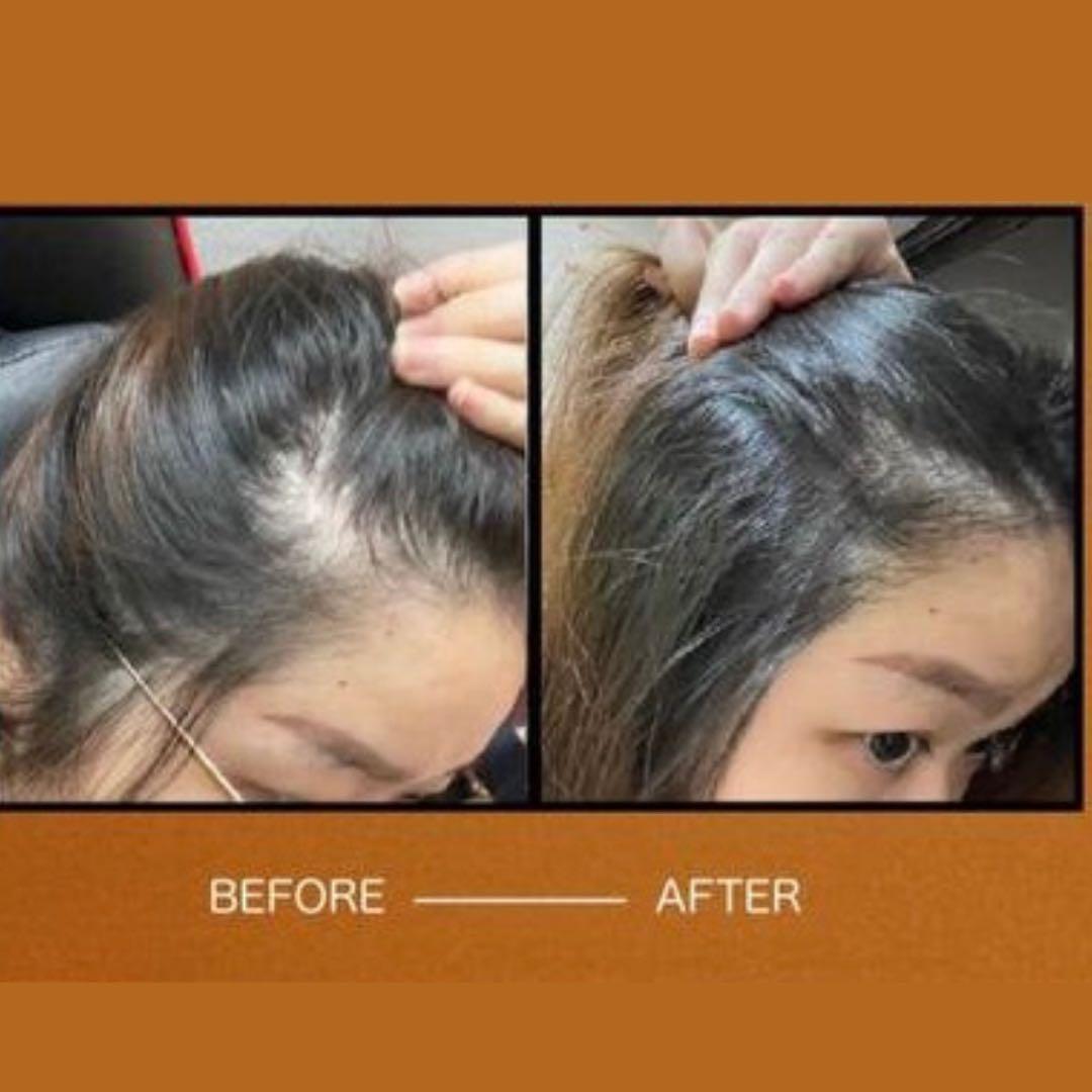 HAIR LOSS AND THINNING HAIR SOLUTION [RUVINE HAIR ESSENCE], Beauty ...