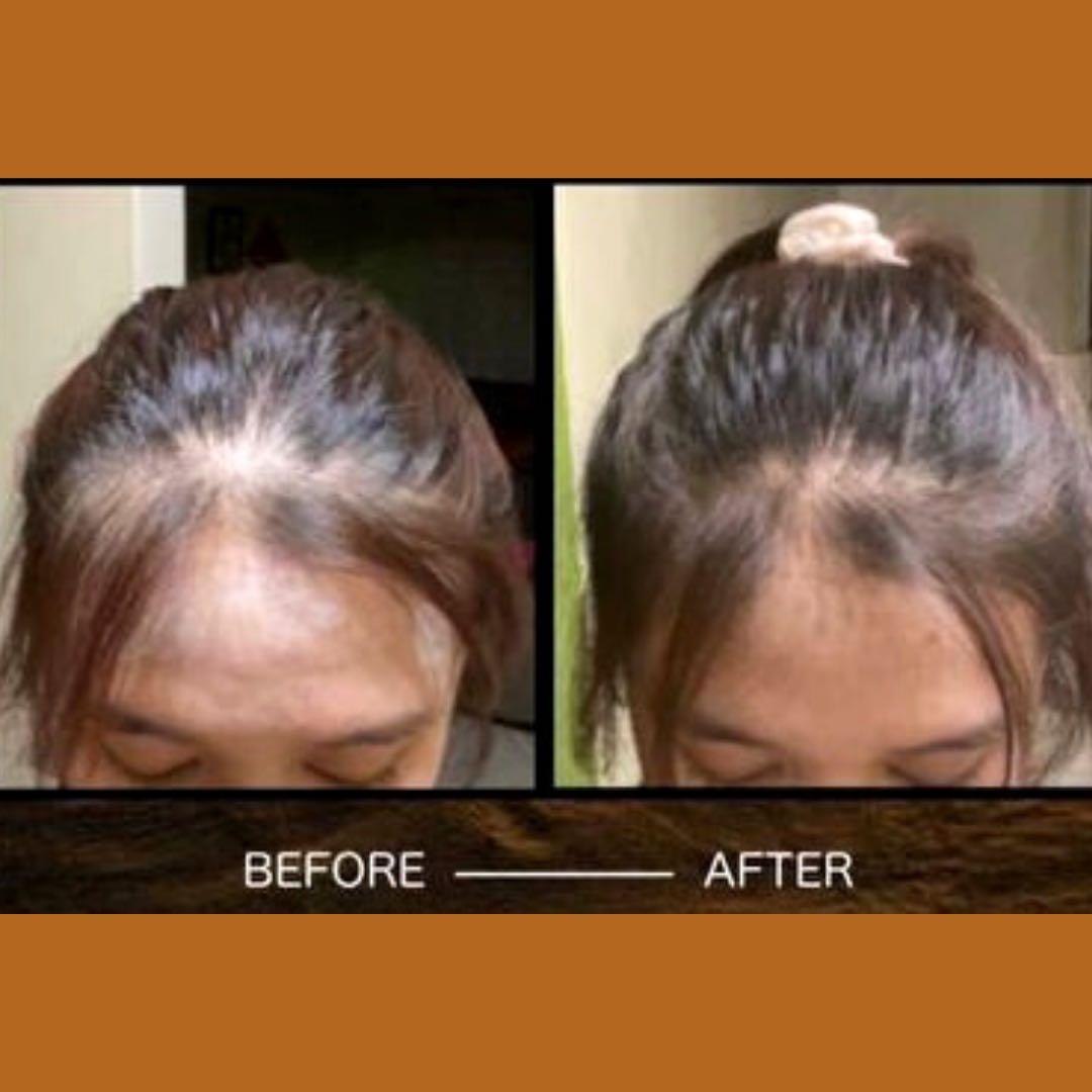 HAIR LOSS AND THINNING HAIR SOLUTION [RUVINE HAIR ESSENCE], Beauty ...