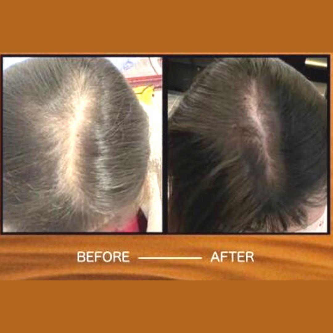 HAIR LOSS AND THINNING HAIR SOLUTION [RUVINE HAIR ESSENCE], Beauty ...