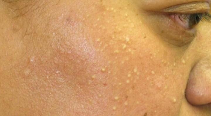 Mole, Milla Seed, Skin Tag,Wart ,Syringoma,Tiny Bump , Xanthelasma ...