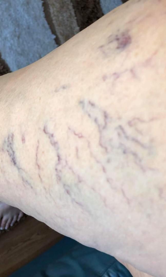 Eczema, varicose veins, skin issues, stretch marks, cellulite, burns ...