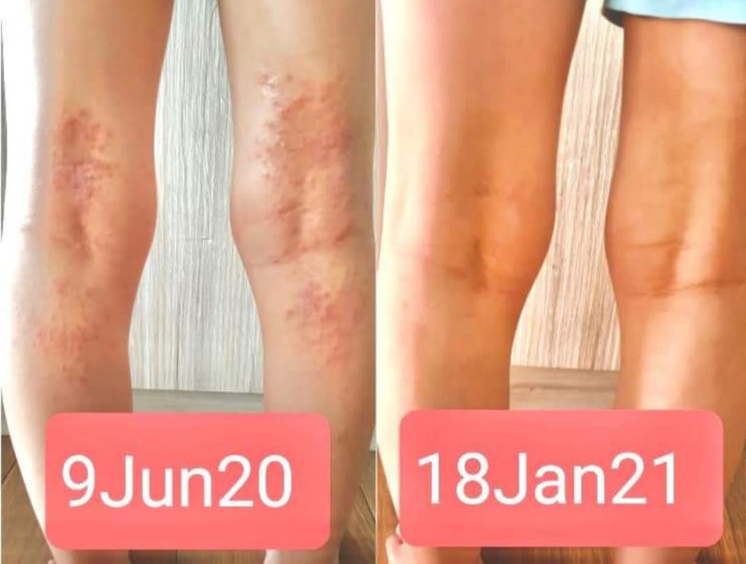 Eczema, varicose veins, skin issues, stretch marks, cellulite, burns ...