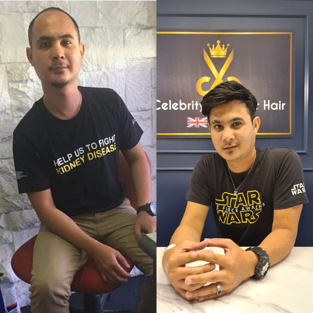 AMx Hair Replacement Rambut Gugur Hair Loss, Beauty & Personal Care ...