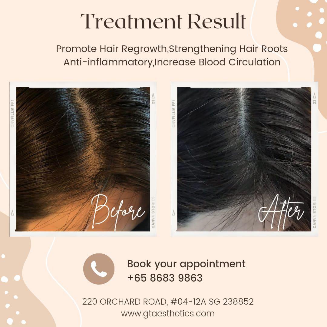 Hair scalp management, Beauty & Personal Care, Hair on Carousell