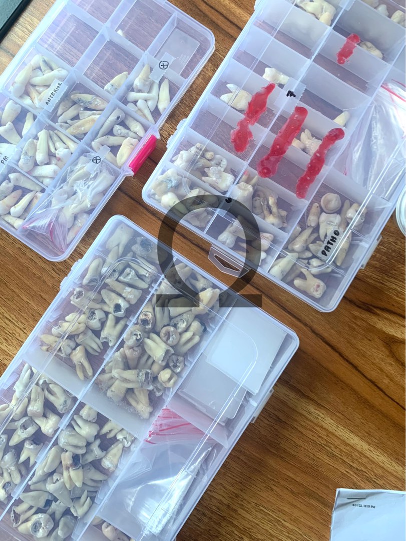 EXTRACTED NATURAL TOOTH SPECIMEN, Health & Nutrition, Medical Supplies ...