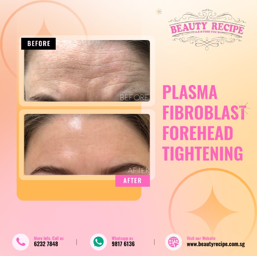 Beauty Recipe Plasma Fibroblast Forehead Tightening & Wrinkles Removal ...