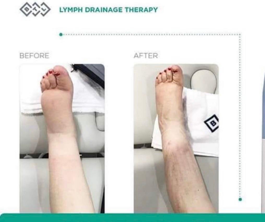 Hari Raya Promo: Authentic BTL Lymphastim (Postnatal massage reduces ...