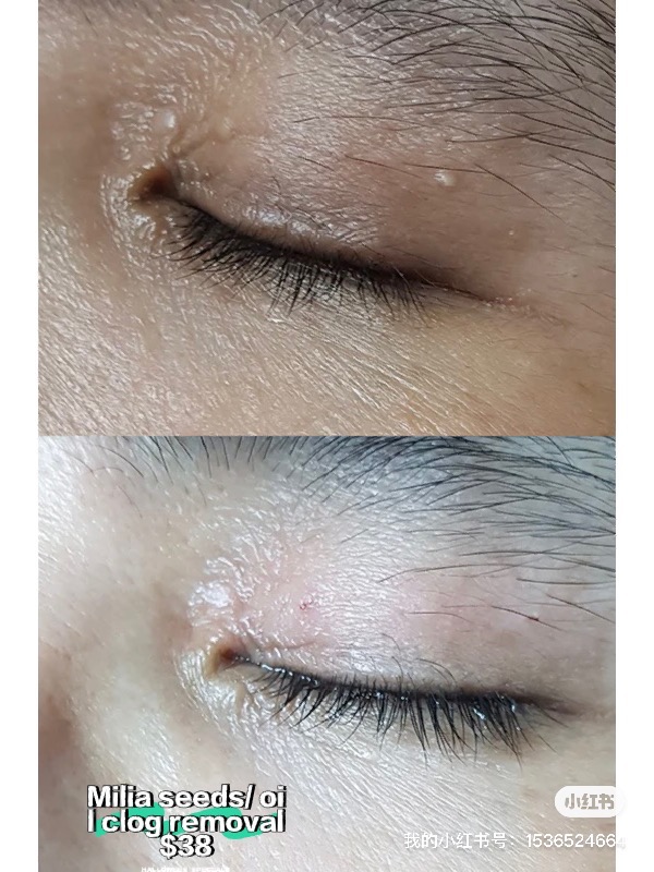 Milia Seeds/ Oil Clog Removal, Beauty & Personal Care, Face, Face Care ...