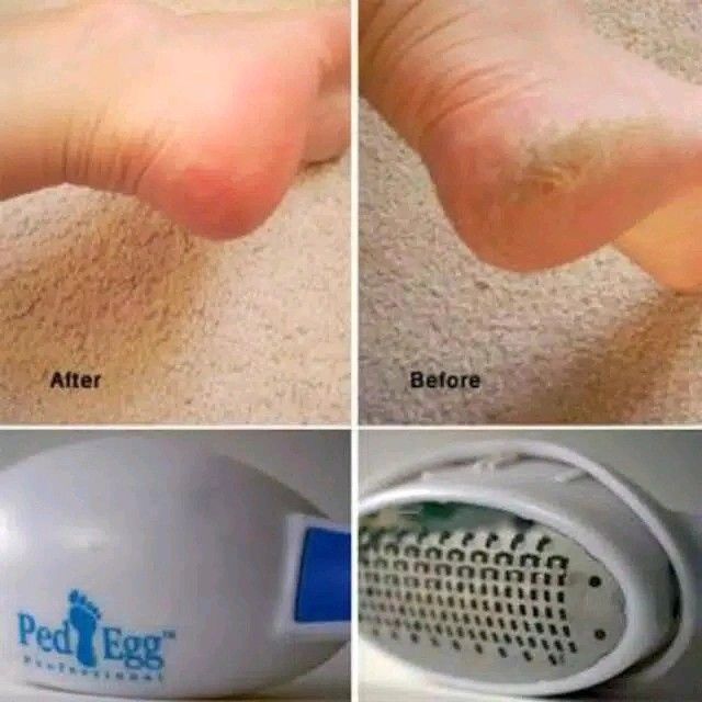 Ped Egg Alat Serut Pembersih Kapalan Kaki Kulit Pecah dan mati + Amplas ...