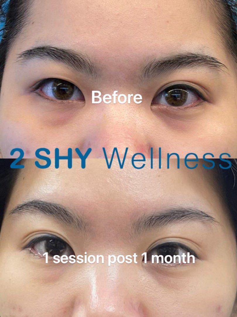 Oct Promo: FDA Medical Grade Eyelids Lift Treatment , Lifestyle ...